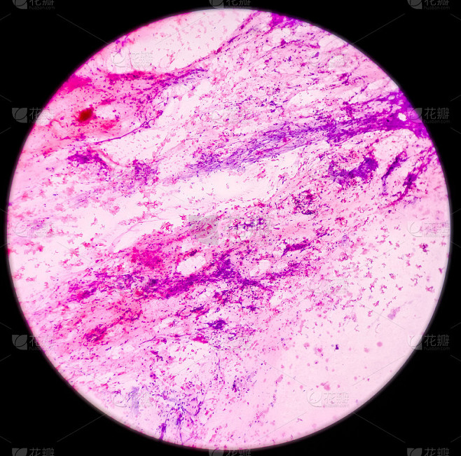 高度鳞状上皮内病变(HSIL)。常规巴氏涂片显微照片。与严重炎症相关的反应性细胞改变