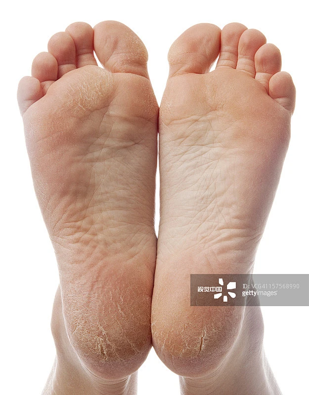 Dry and cracked soles of feet on white background-花瓣网