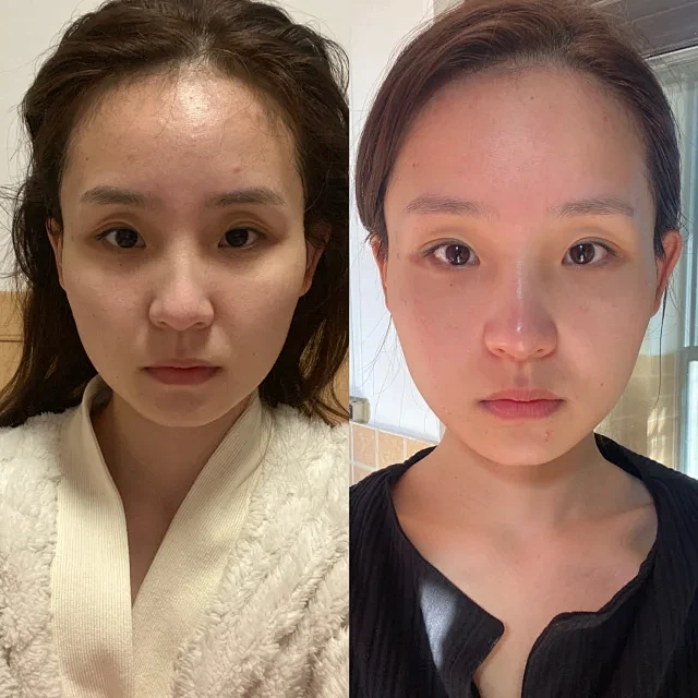 去法令纹对比图 - 小红书搜索-花瓣网