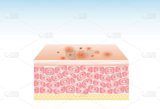 acne skin spot pimple problem vector design.
