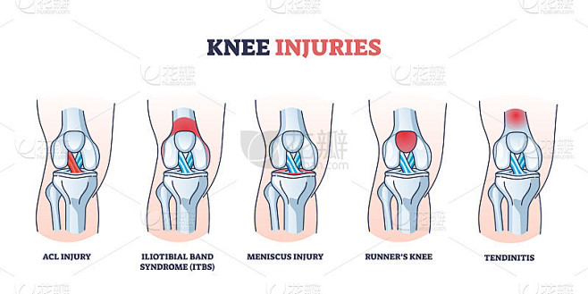 膝关节损伤伴医用骨、韧带和肌肉外伤轮廓图