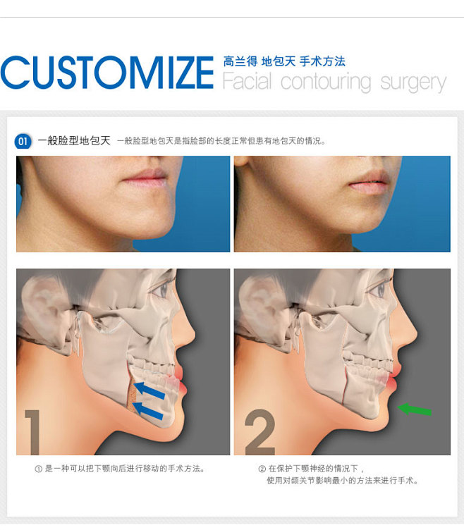 protruding-chin-correction_8