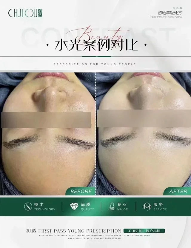 水光针前后对比图 - 小红书搜索-花瓣网