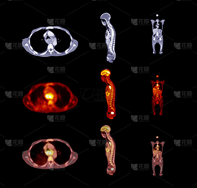 PET CT全身扫描图像的比较轴面、矢状面和平面用于检测癌症复发患者的癌症疾病。