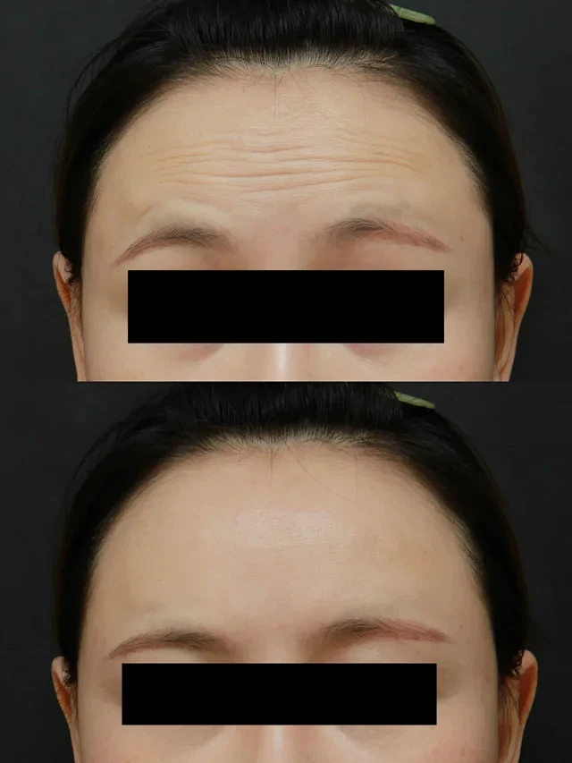 抬头纹去除对比图 - 小红书搜索-花瓣网