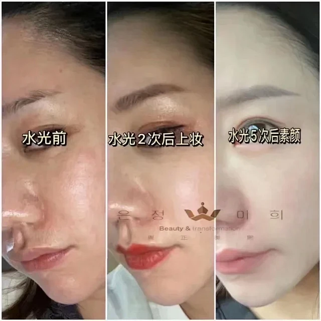 水光针前后对比图 - 小红书搜索-花瓣网