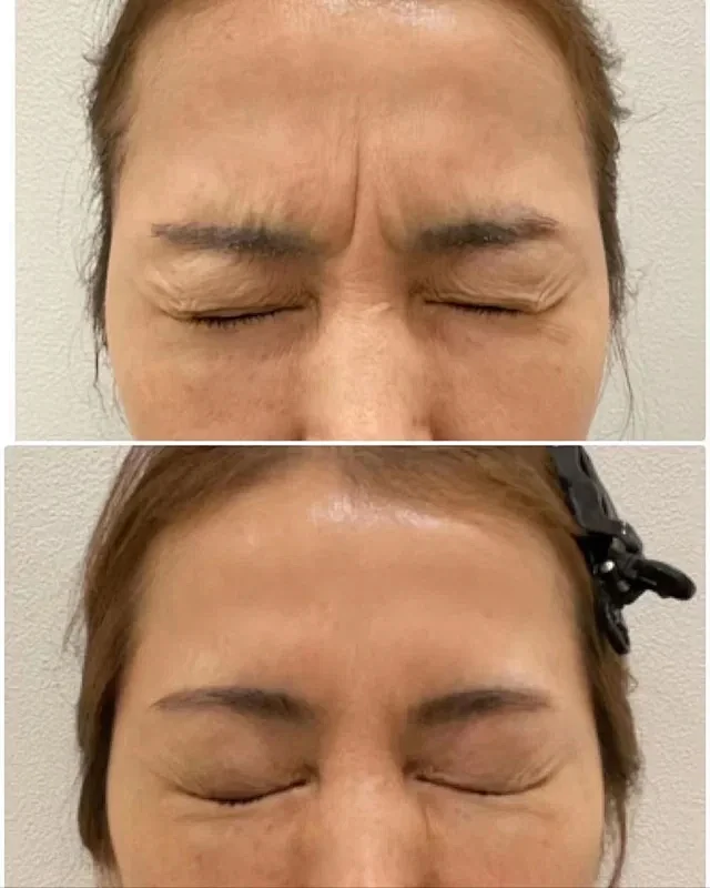 川字纹去除对比图 - 小红书搜索-花瓣网