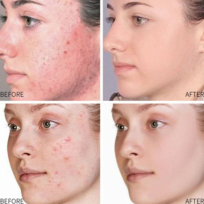 Crema per il trattamento dell'acne crema per la riparazione della pelle ...