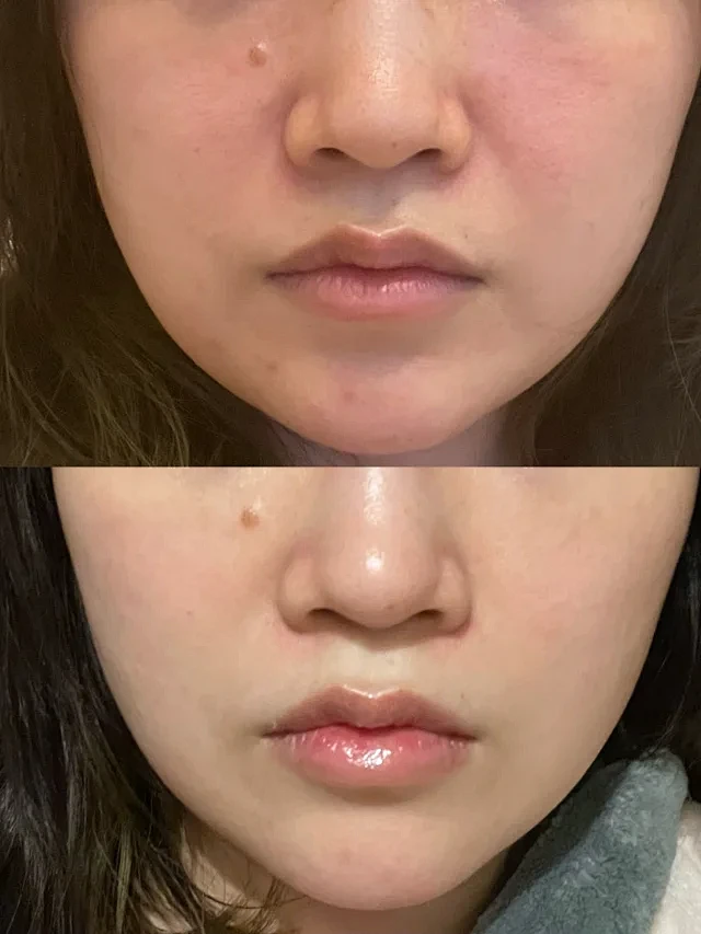 去法令纹对比图 - 小红书搜索-花瓣网