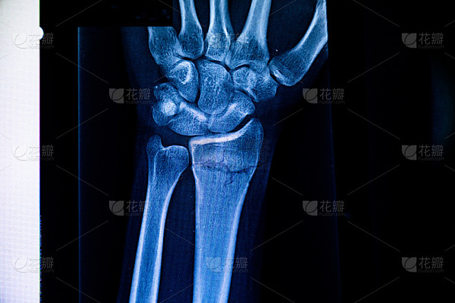 桡骨骨折的影像学检查。人类手臂x射线。手部骨骼的x光片。医学放射学技术。x射线胶片。