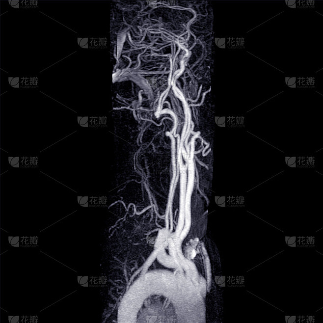 MRI(magnetic resonance venography，磁共振静脉造影)人脑中的静脉。