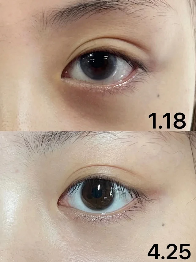 去除黑眼圈前后对比 - 小红书搜索-花瓣网