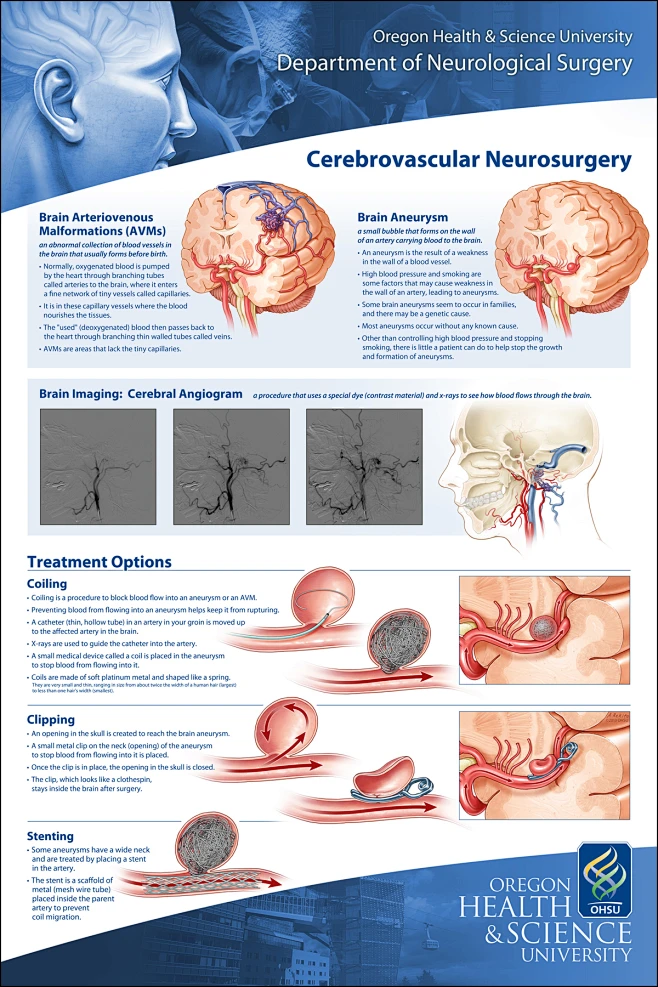 Neurosurgery Posters : Academic posters on various Neurosurgical topics ...