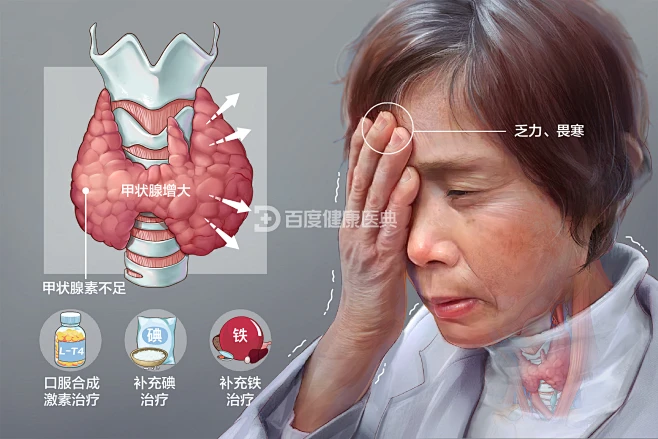 甲状腺功能减退-花瓣网