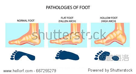 Foot pathologies. Normal, flat and hollow foot. Foot types. Skeletal ...