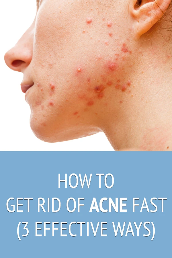 How To Get Rid of Acne Fast (3 Effective Ways)-花瓣网