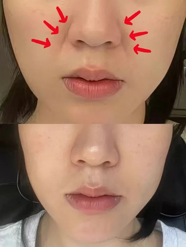 去法令纹对比图 - 小红书搜索-花瓣网