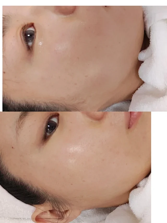 水光针前后对比图 - 小红书搜索-花瓣网