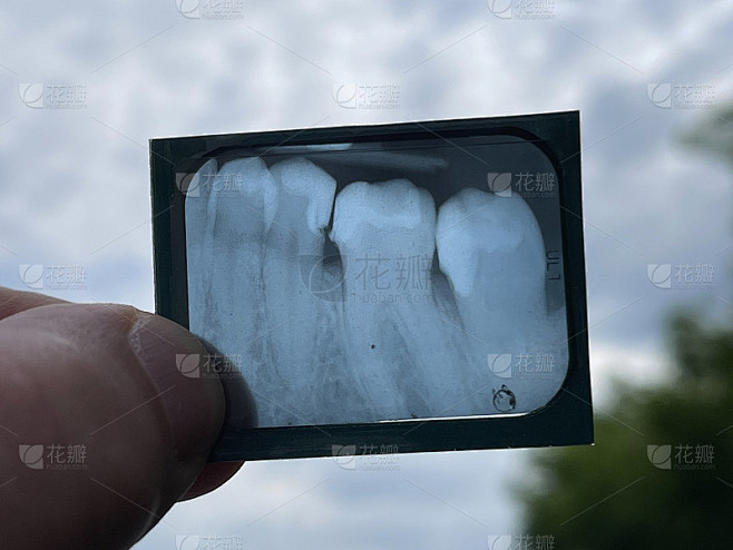 牙齿的x光映在天空中