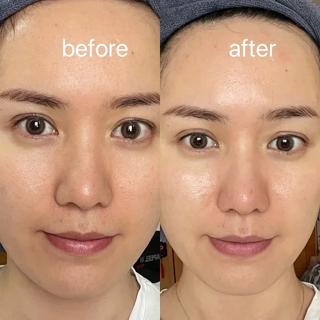 水光针前后对比图 - 小红书搜索-花瓣网