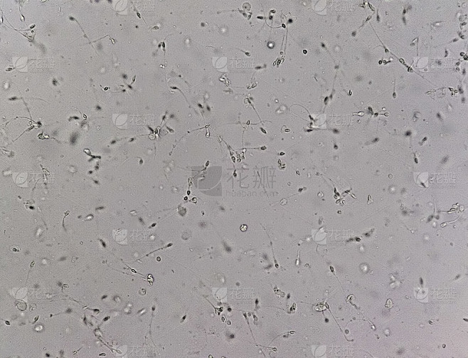 弱精子症的精液分析显微照片。