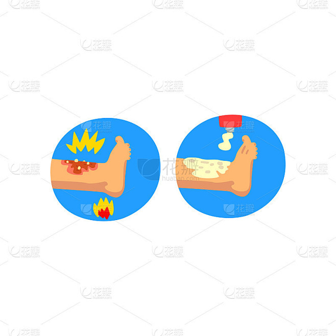 Thermal skin burn of leg, first aid and treatment