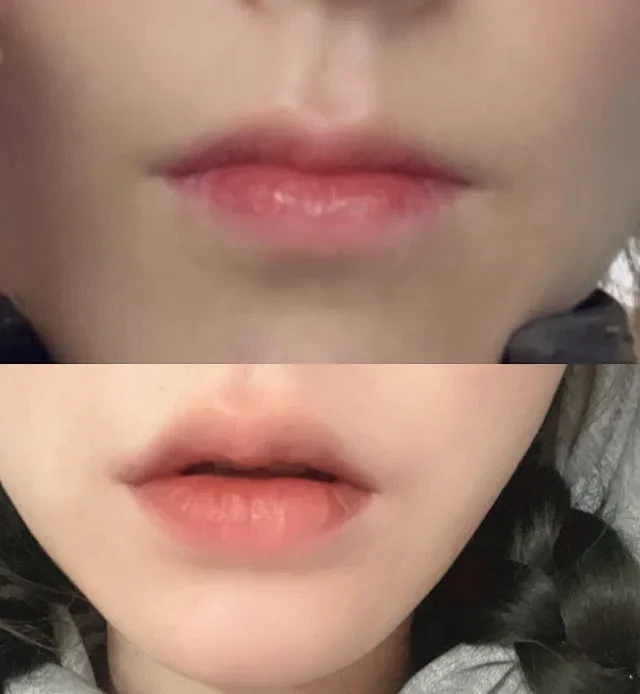 玻尿酸嘴唇对比图 - 小红书搜索-花瓣网