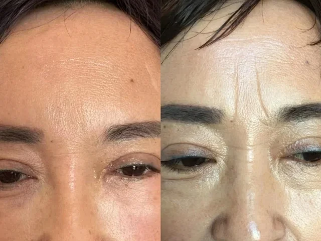 川字纹去除对比图 - 小红书搜索-花瓣网