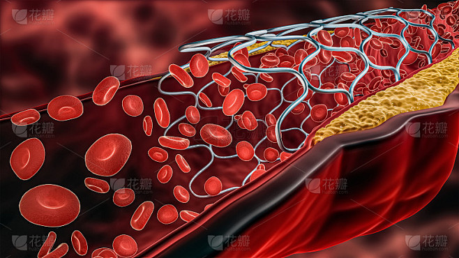 血管成形术三维渲染图。支架放置在病变动脉或血管中，血管被胆固醇或动脉粥样硬化斑块堵塞，伴随血流。外科