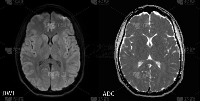 正常脑MRI(高分辨率)DWI弥散加权成像及ADC图