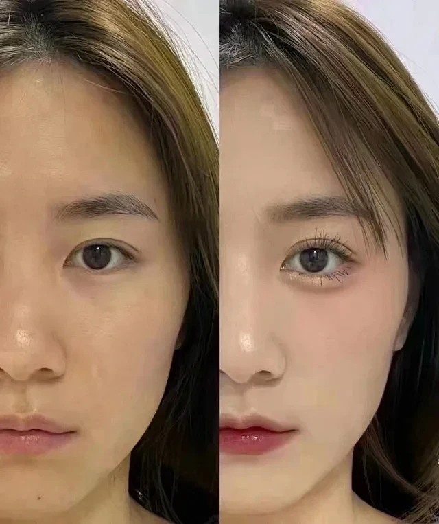 卧蚕注射前后对比 - 小红书搜索-花瓣网