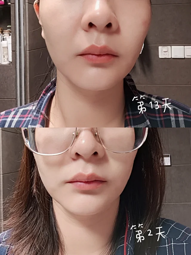 水光针前后对比图 - 小红书搜索-花瓣网