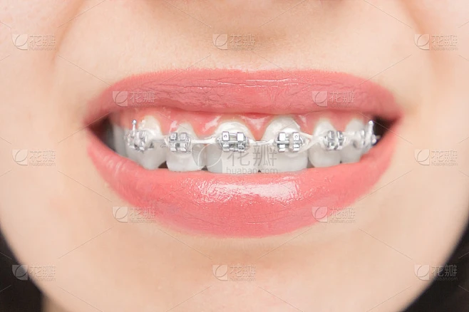 Close up to dental braces. Brackets on the teeth a素材-花瓣网