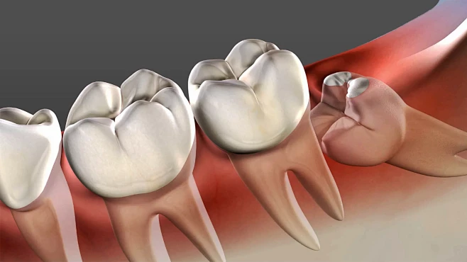 Wisdom Tooth Bone Graft - Is It Necessary? : Is it necessary to get a ...