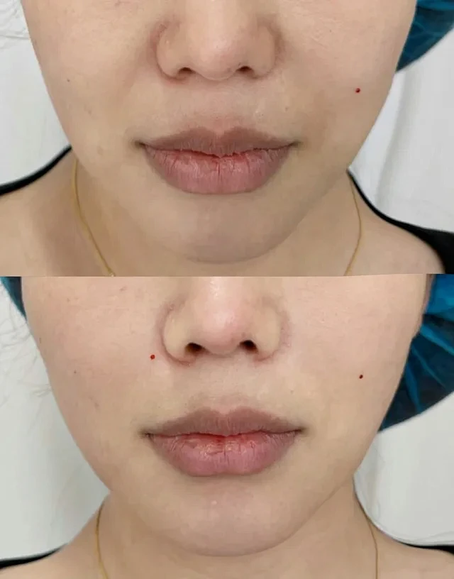 去法令纹对比图 - 小红书搜索-花瓣网