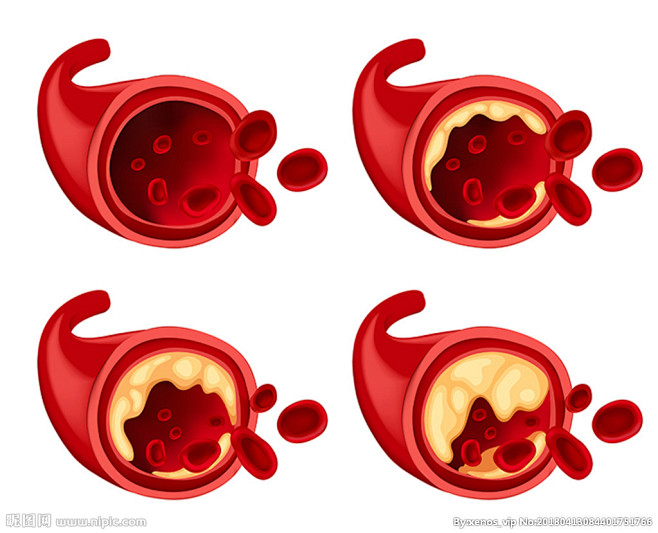 心血管病产生的过程插图