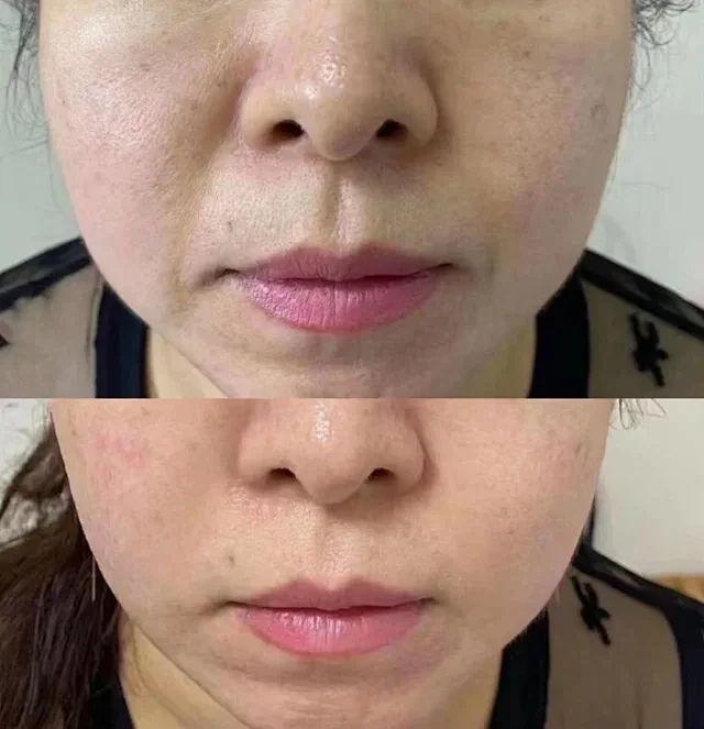 去法令纹对比图 - 小红书搜索-花瓣网