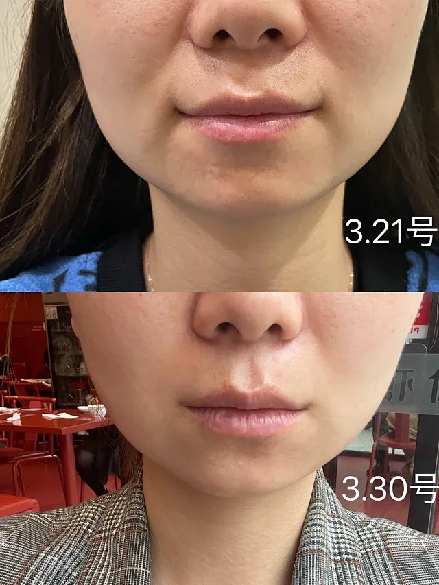 去法令纹对比图 - 小红书搜索-花瓣网