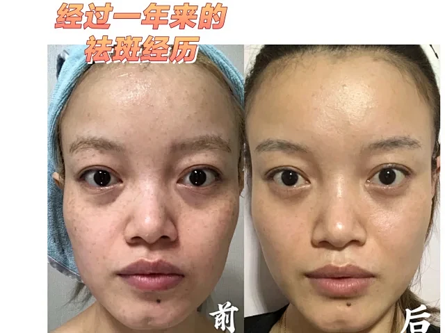皮秒祛斑对比图 - 小红书搜索-花瓣网