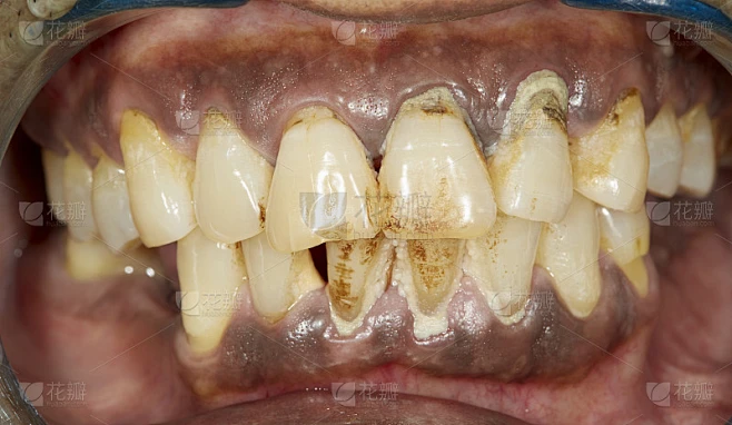 牙周炎素材-花瓣网