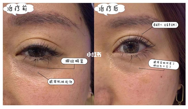 最近爆火的7D聚拉提效果对比图 : 7D聚拉提抗衰治疗原理 通过热效应可刺激皮下胶原或纤维蛋白收缩、新生，同步达到显着的除皱、嫩肤、紧肤、塑形 ...