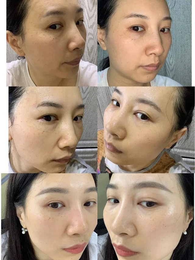 皮秒祛斑对比图 - 小红书搜索-花瓣网
