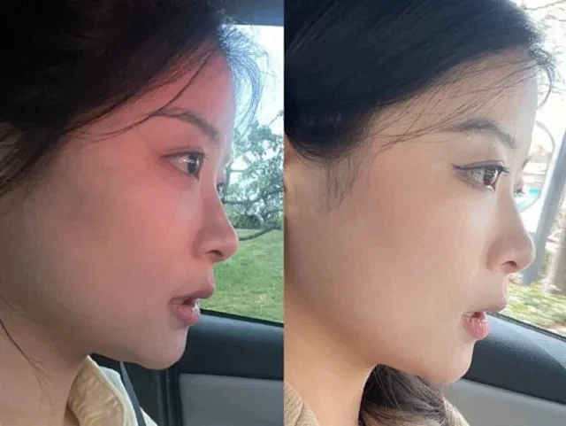 超声炮前后对比图 - 小红书搜索图片_超声炮图片素材-花瓣网