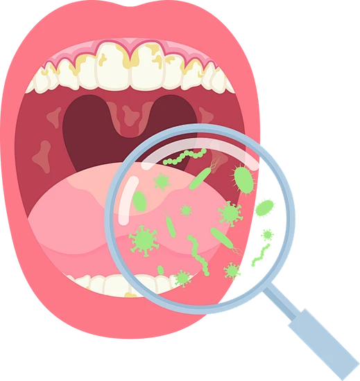 bad breath gingivitis bacteria thrush plaque teeth mouth oral halitosis ...