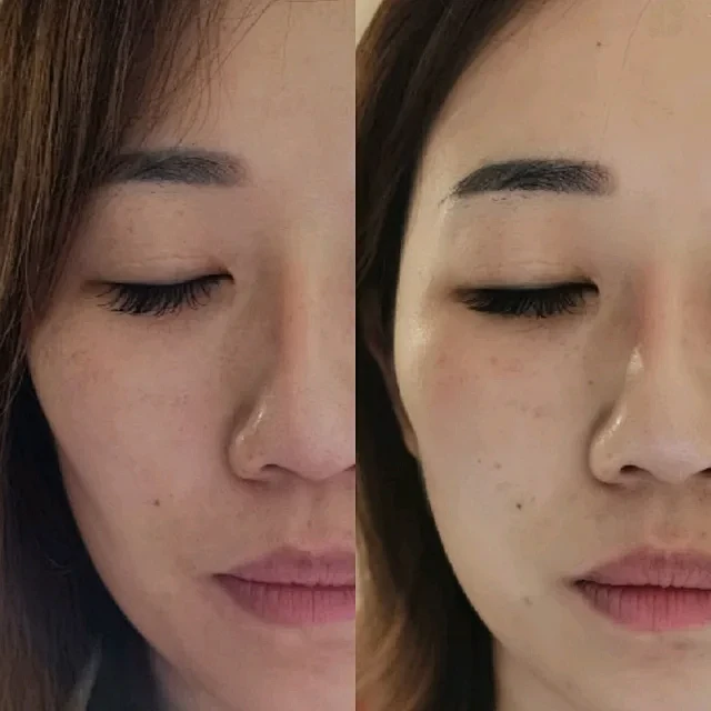 皮秒祛斑对比图 - 小红书搜索-花瓣网