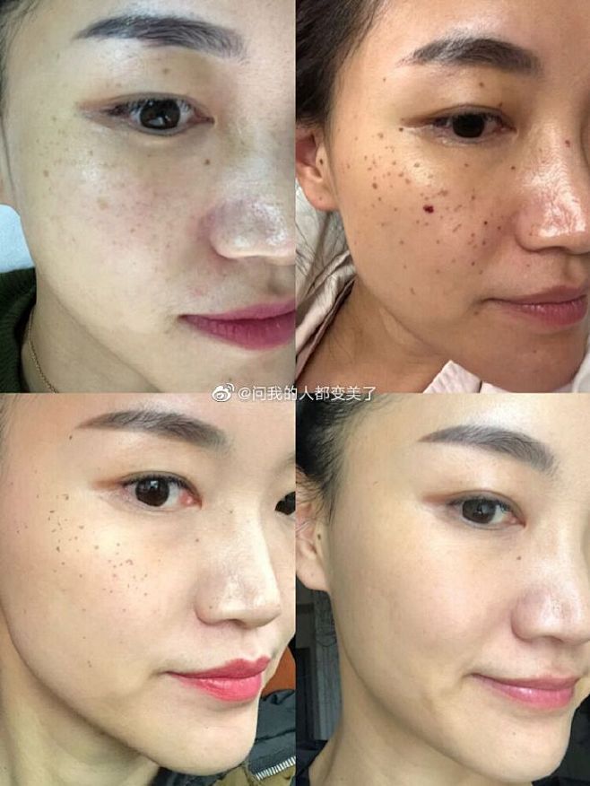 第一次皮秒祛斑 后，高清无p图 做完结痂的时候说实话比之前还难看，有点密聚恐惧症的人还是不要看吧，但是一周结痂掉了过后会很惊喜喔，皮肤像剥了壳的鸡蛋，很嫩很干净。
