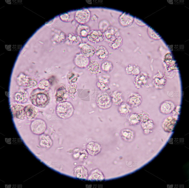 显微镜下尿液标本中的白细胞和细菌