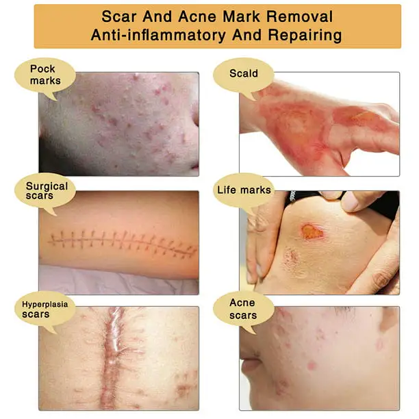 ALIVER Scar Cream - TCM Scar and Acne Mark Removal Gel Ointment for ...