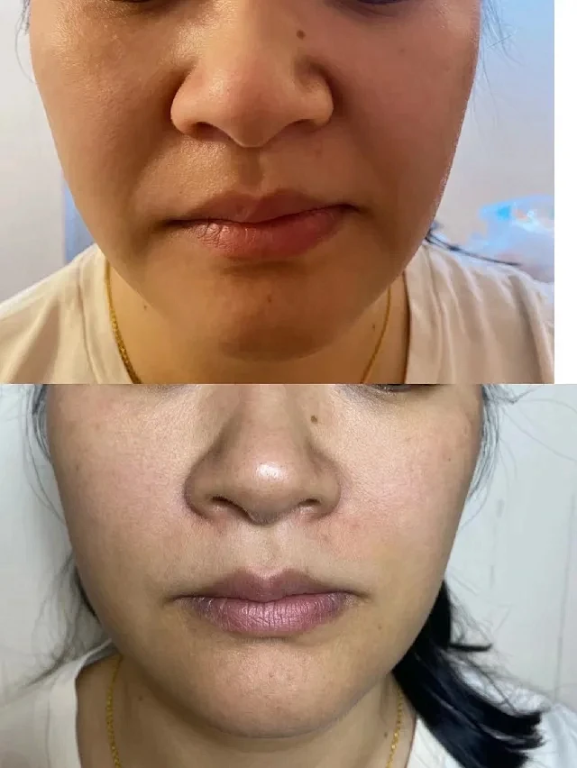 美业案例对比图 - 小红书搜索-花瓣网