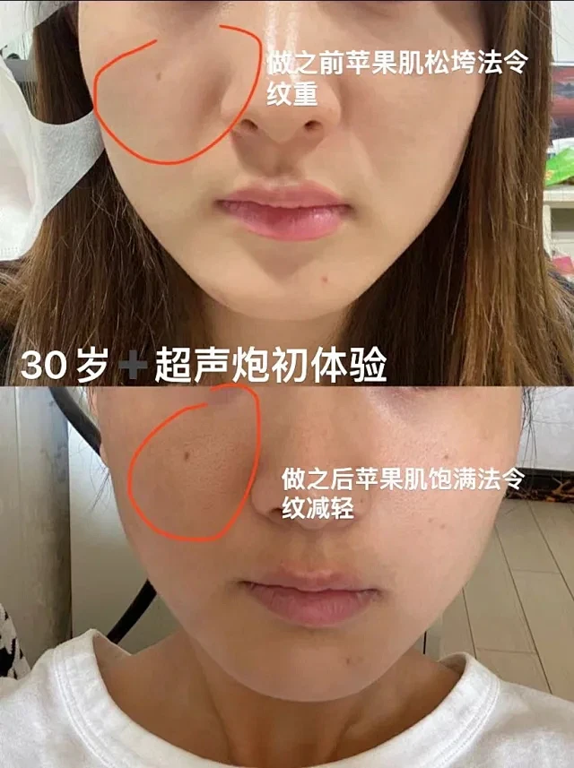 超声炮前后对比图 - 小红书搜索-花瓣网